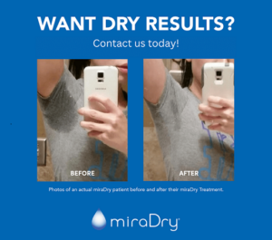 miraDry in Newport Beach, CA | Excessive Sweating Treatment